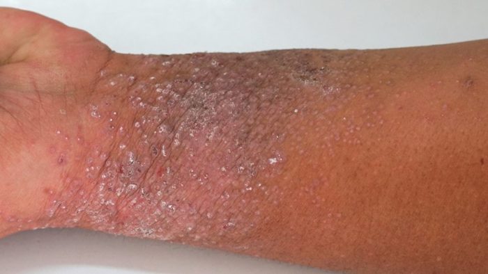 ATOPIC DERMATITIS – Dermatology Conditions and Treatments