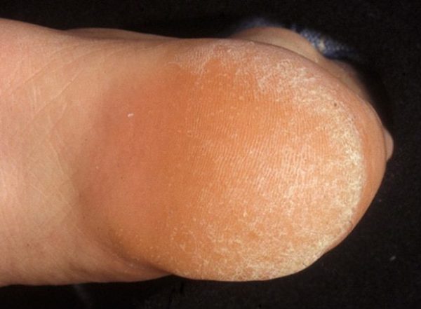 CALLUS – Dermatology Conditions and Treatments