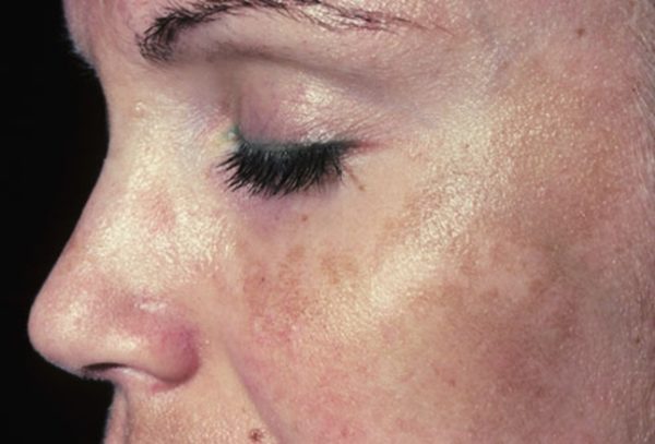 MELASMA – Dermatology Conditions and Treatments
