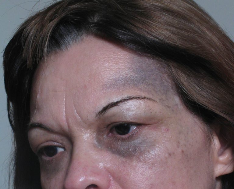 Nevus Of Ota Dermatology Conditions And Treatments