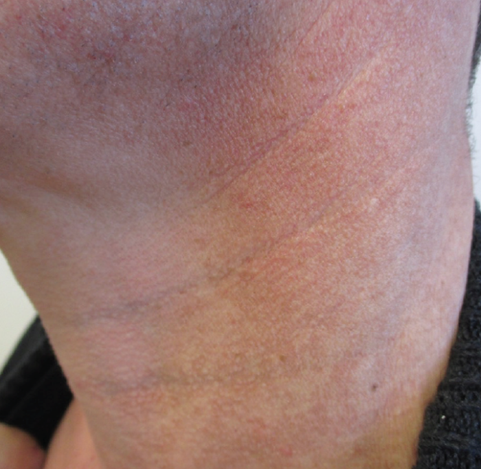 POIKILODERMA – Dermatology Conditions and Treatments