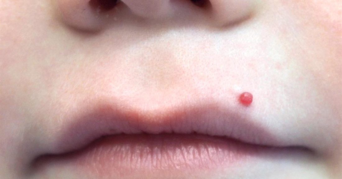 PYOGENIC GRANULOMA – Dermatology Conditions and Treatments