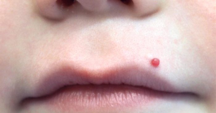PYOGENIC GRANULOMA – Dermatology Conditions and Treatments