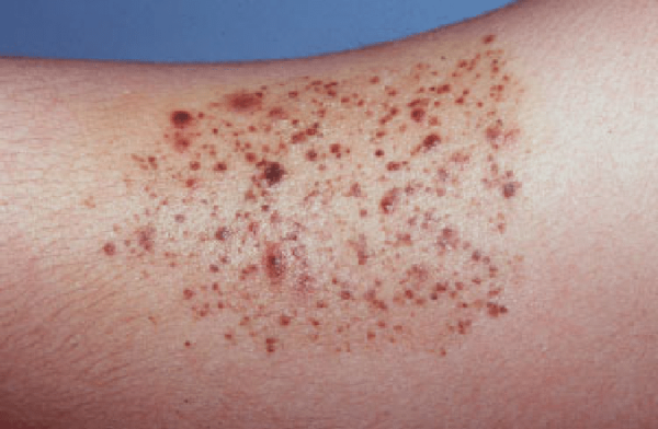 Speckled Nevus Dermatology Conditions And Treatments