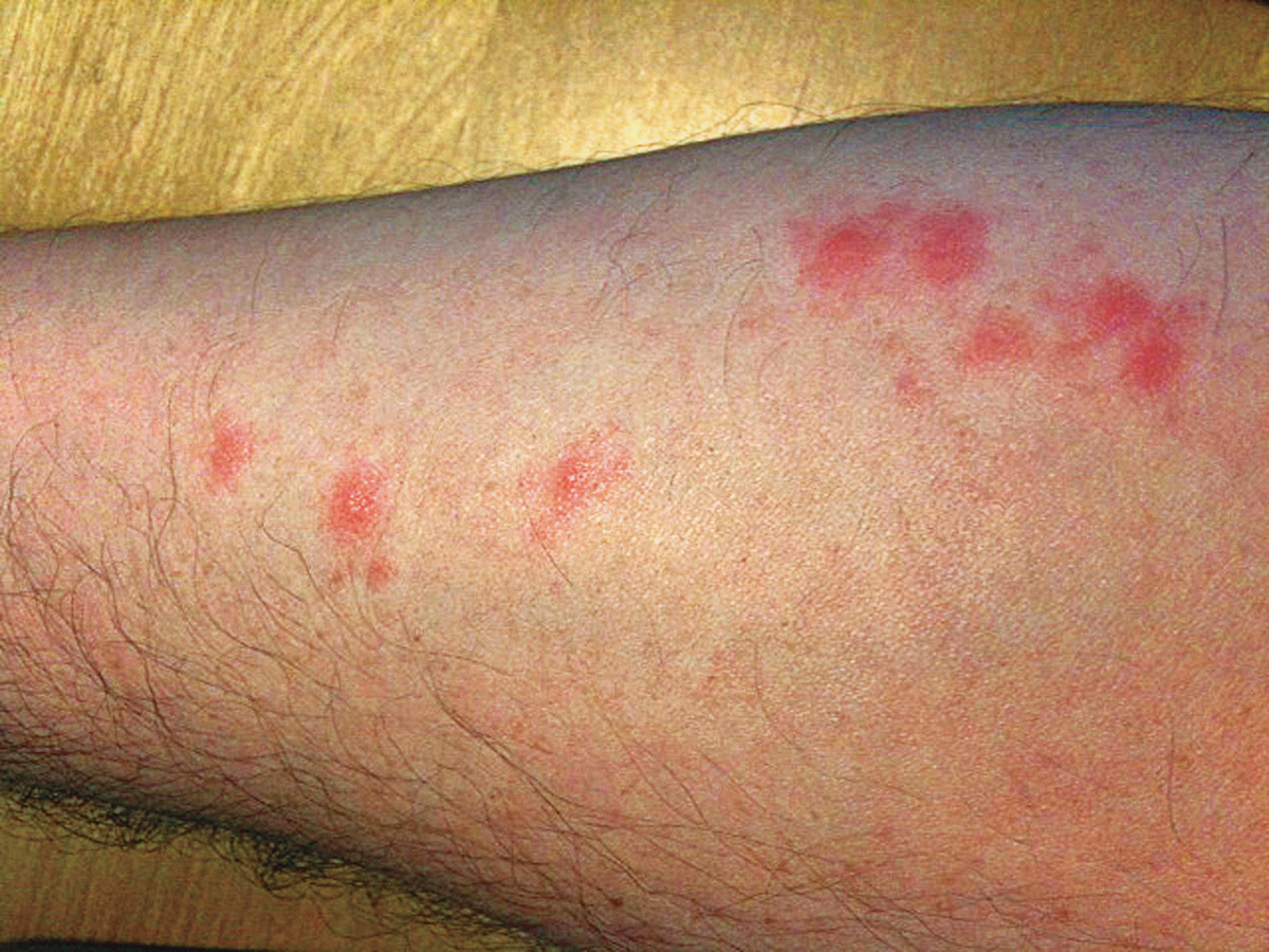 BED BUG BITES – Dermatology Conditions and Treatments
