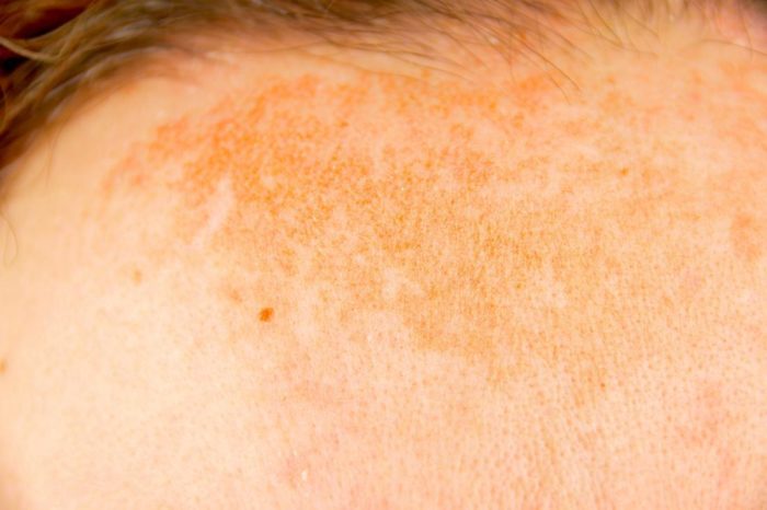 HYPER PIGMENTATION – Dermatology Conditions and Treatments