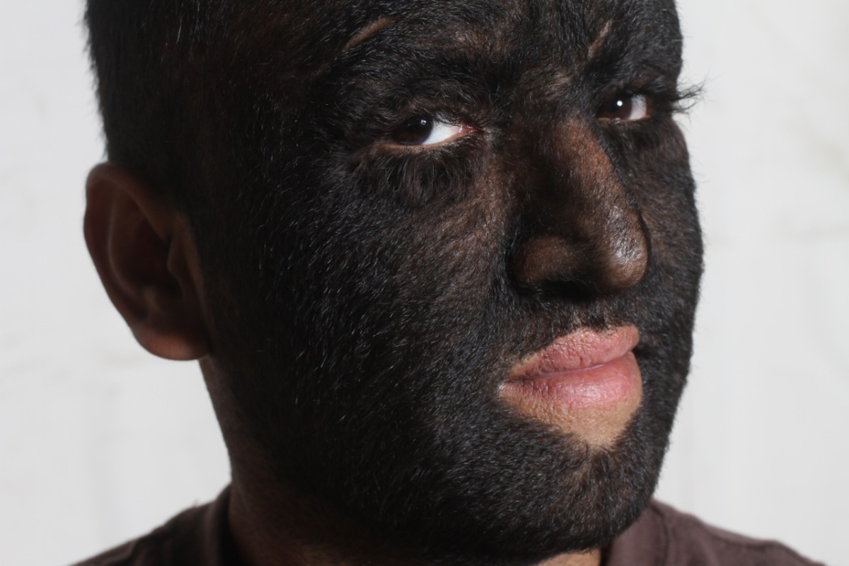 HYPERTRICHOSIS Dermatology Conditions And Treatments HYPERTRICHOSIS Dermatology Conditions And Treatments