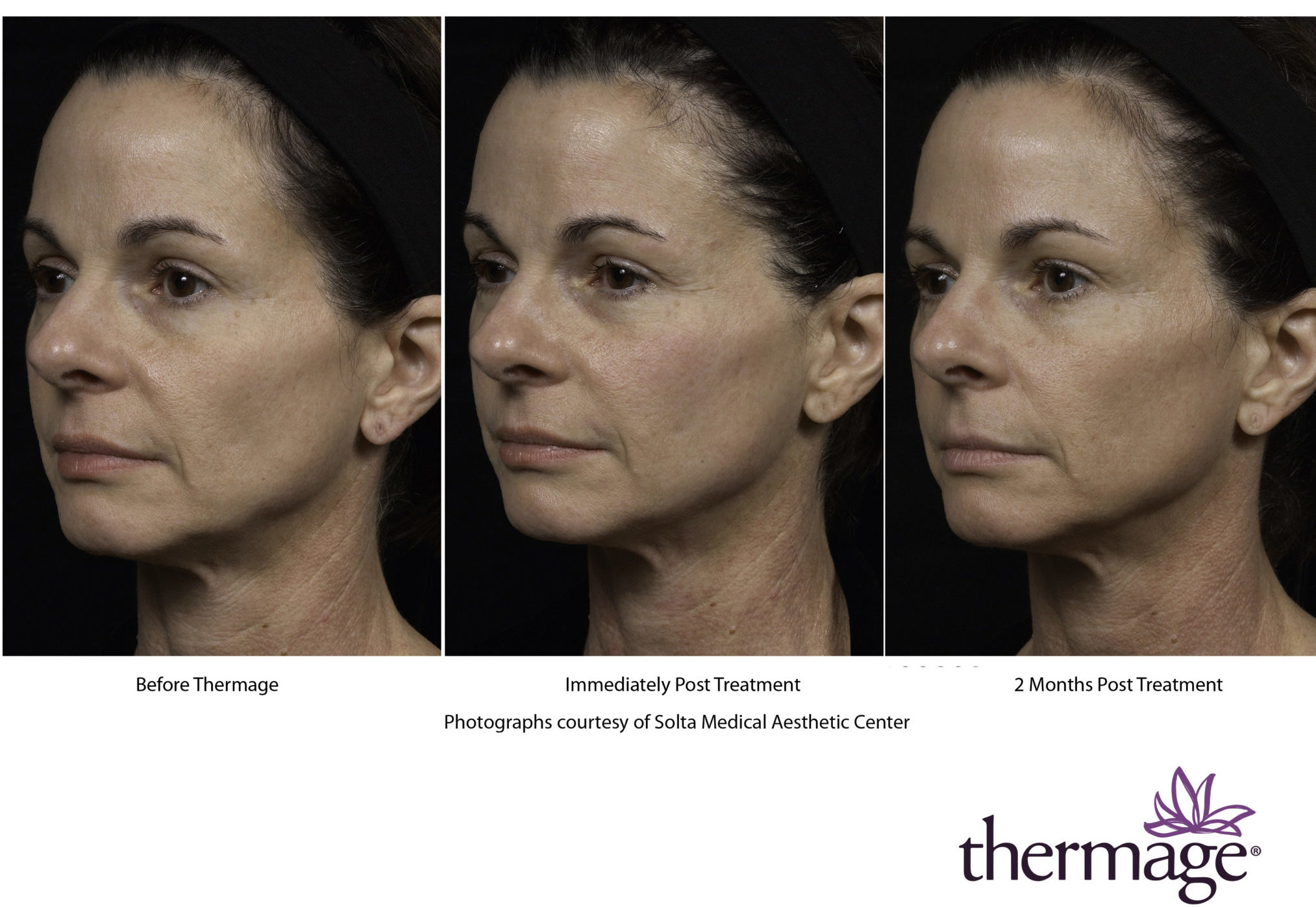 THERMAGE – Dermatology Conditions and Treatments